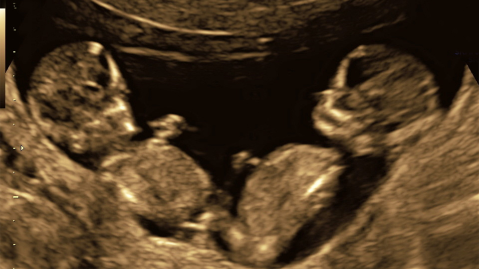 Killing a twin in the womb now seen as normal practice in IVF and ...