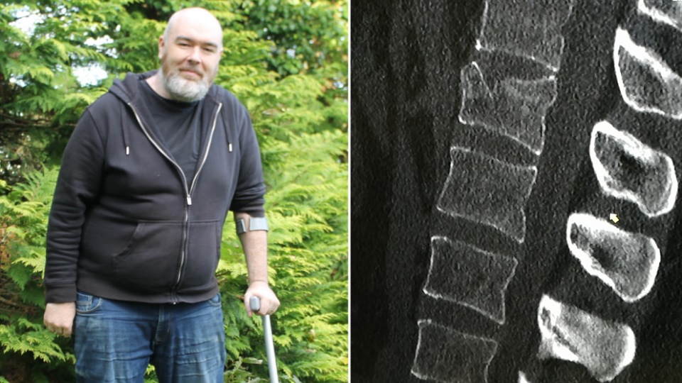 ‘I broke my spine but can’t get disability allowance’ - Gript